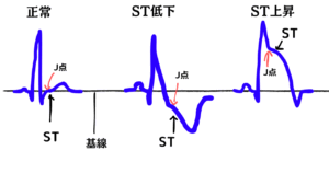 心電図ST変化ってなぜ起こる？疑われる疾患や機序は？ | もんたの情報発信部