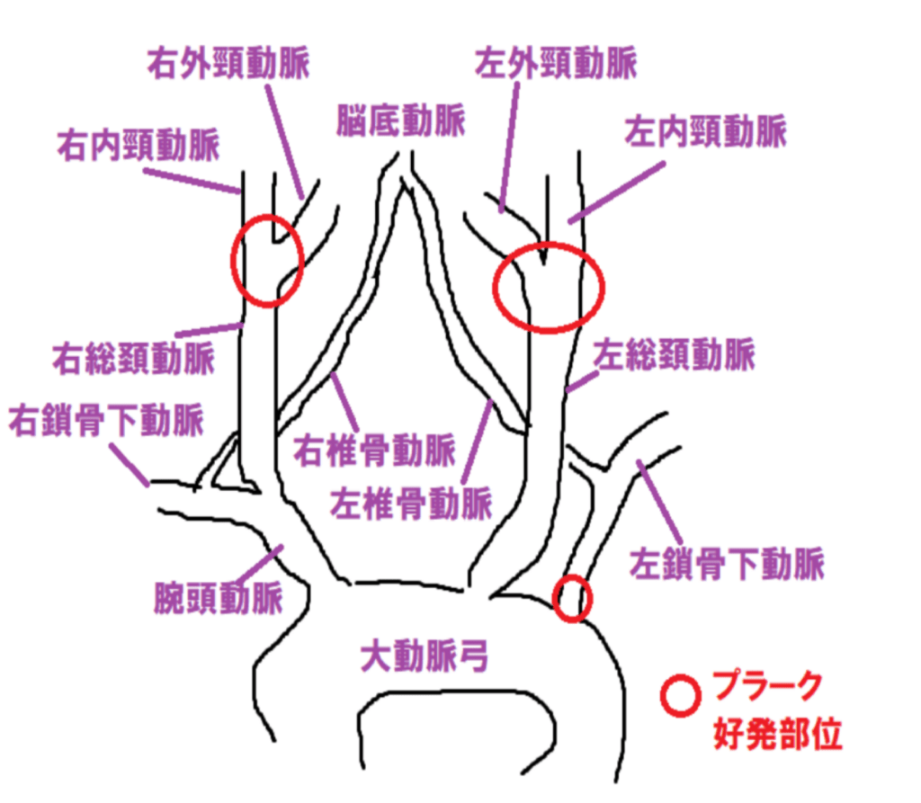 頸動脈エコーのスクリーニング方法は？現役検査技師が行う検査方法を評価も含めて紹介 もんたの情報発信部